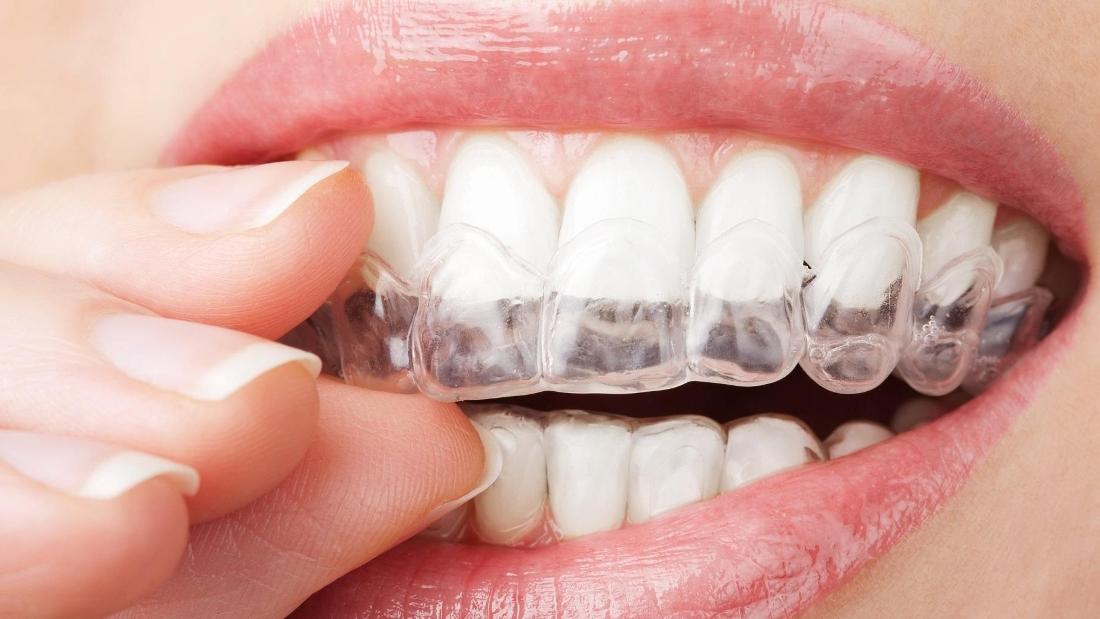 3 Top Benefits of Invisalign® Treatment | Invisalign® St. Augustine FL